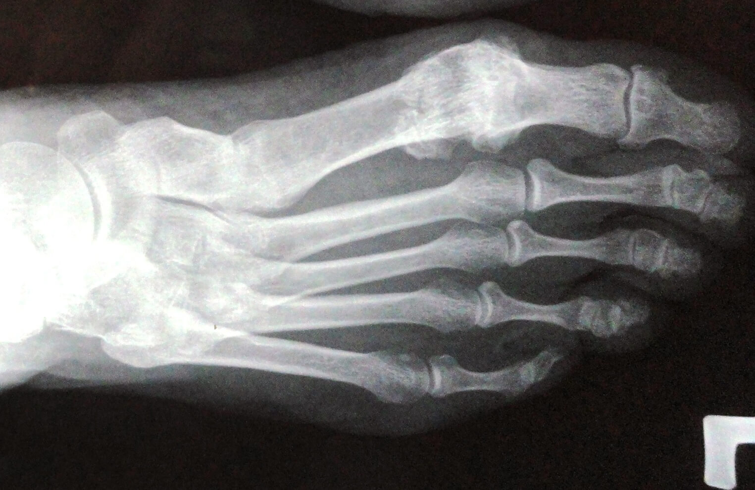 Operacje palucha sztywnego | Centrum Medyczne Medicum Warszawa